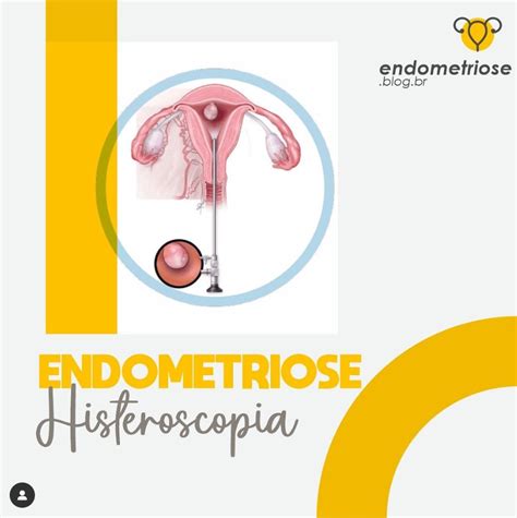 Histeroscopia