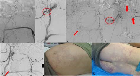Embolization Of Urinary Bladder For The Treatment Of Intractable