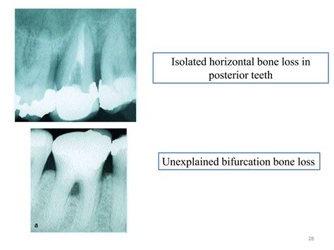 Vertical Root Fracture And Its Management Pptx Dental Health