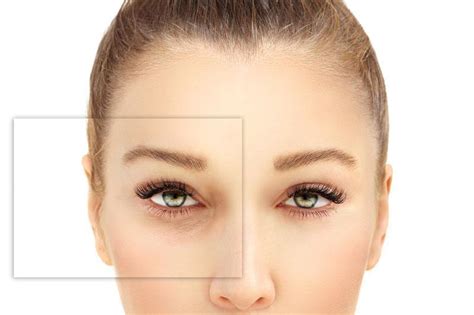 Blefaroplastica Superiore Sesto San Giovanni Studio Di Chirurgia