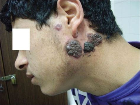 Use Of Topical Povidone Iodine Resulting In A Iododerma Pmc