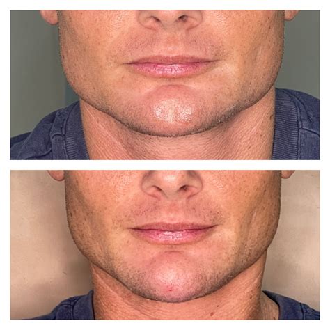 Chin Dimpling Treatment Volumiser Brisbane Hamilton Skin Clinic