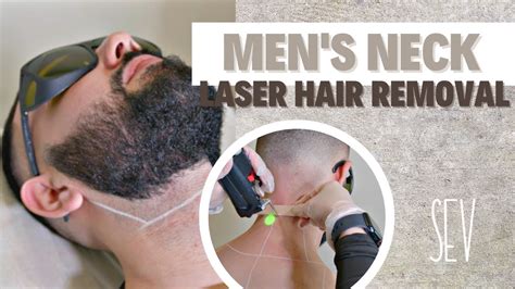 Laser Hair Removal On Neck At Chloe Dunbar Blog