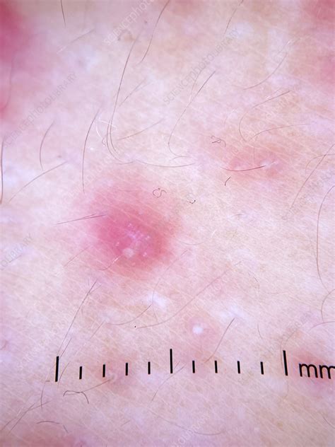 Folliculitis Dermoscopy Stock Image C056 0941 Science Photo Library