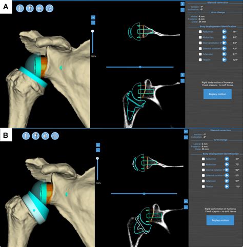 Is Preoperative 3d Planning Reliable For Predicting Postoperative