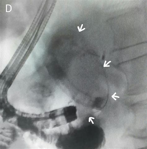 Ercp And Egd Stenting A Malignant Duodenal Stricture