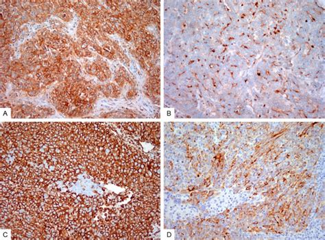 sarcomatoid combined hepatocellular cholangiocarcinoma a case report