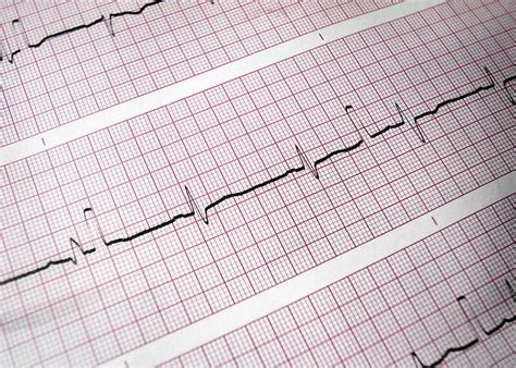 Sex Differences In Cardiac Arrhythmias Our Bodies Ourselves