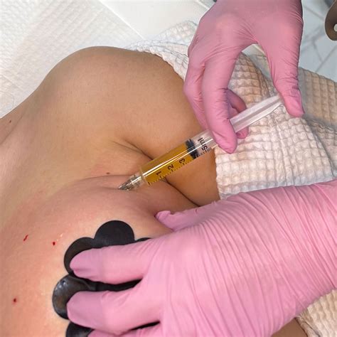 Prp Breast Lift In Kingwood Vampire Breast Lift Rénove Medical Spa