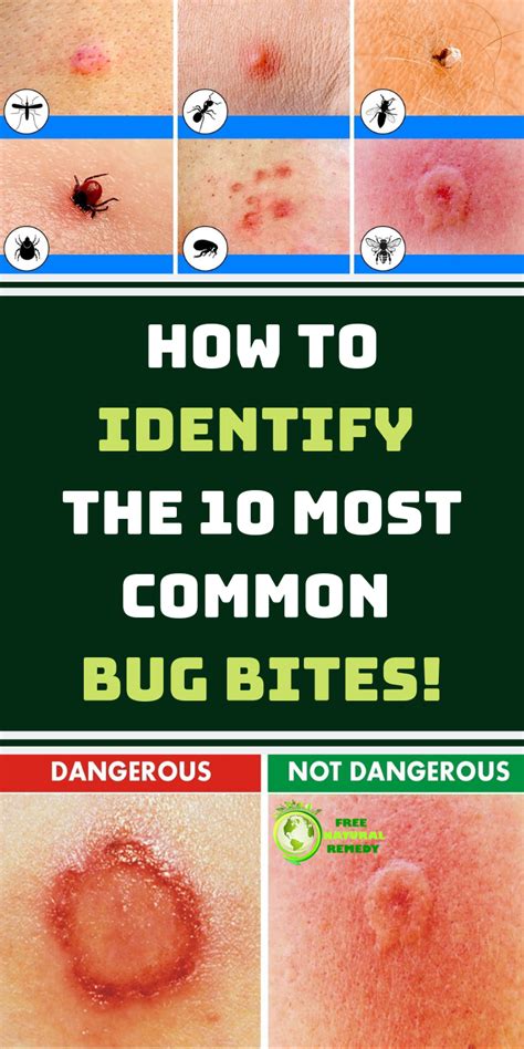 How To Identify The 10 Most Common Bug Bites Bug Bites Natural Remedies Remedies