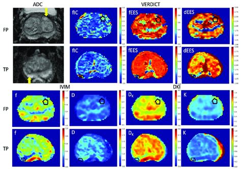 Parametric Maps Obtained Using The Ivim Dki And Verdict Models In A