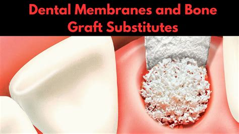 Top 10 Companies In Dental Membranes And Bone Graft Substitutes Market