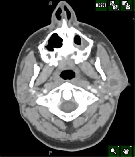 Contrast Enhanced Ct Demonstrating Left Parotid Abscess In A Setting Of