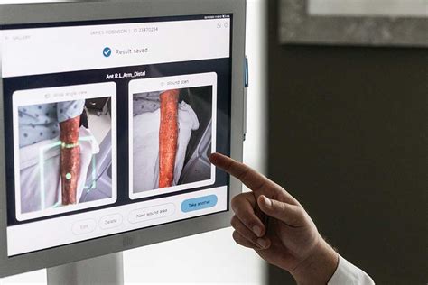 Deep Full Thickness Burn Diagnosis Full Thickness Burns