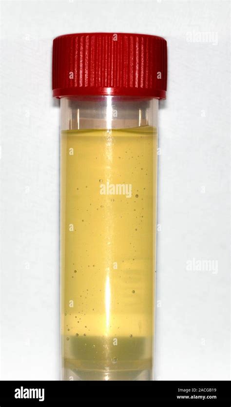 Specimen Bottle Of Urine From A Patient Showing Slightly Cloudy Urine