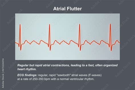 ECG In Atrial Flutter An Abnormal Heart Rhythm Characterized By Rapid Regular Contractions Of