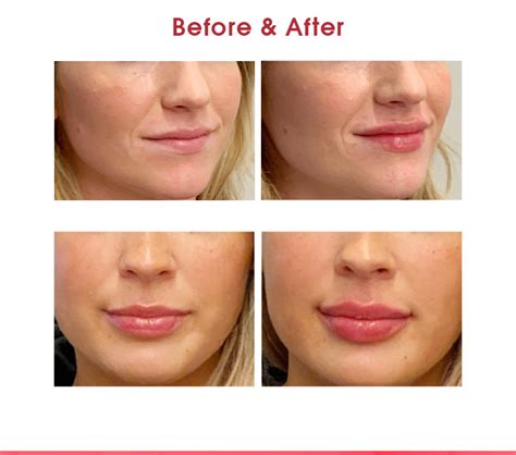 Thin Lips Lip Filler