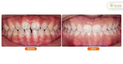 Niềng răng đóng khe thưa trẻ em KH Trần Trung Hiếu HN6250