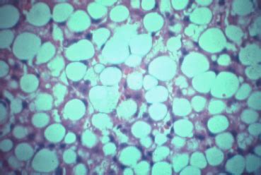 Diffuse Liver Pathology Flashcards Quizlet