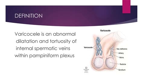 Varicocele Presentation Ppt Akdjfjfjskacnnxnznxnc Pptx Infertility Reproductive Health