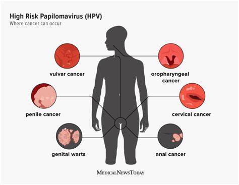 Uwc Helps In The Fight Against Human Papilloma Uwc