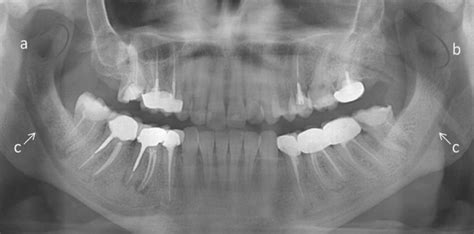 Panoramic Radiograph Revealed An Unusual Radiolucency On The Coronoid Download Scientific