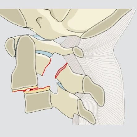 AO Spine Classification Calculator For Trauma Rad At Hand