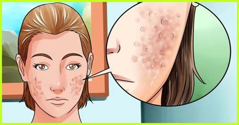 Acne And Blemishes Dr Health Clinic