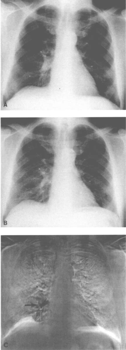 Scheme Of Chest Temporal Subtraction By Automated Initial Image Matching Download Scientific