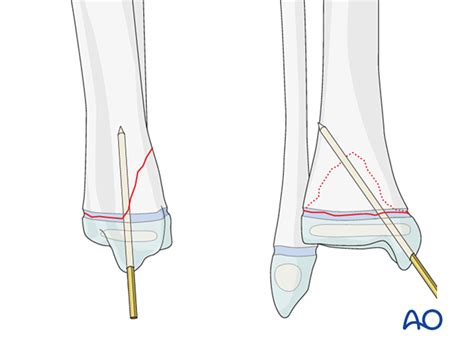 Open Reduction K Wire Fixation For Epiphysiolysis With Metaphyseal Wedge Salter Harris Ii Of