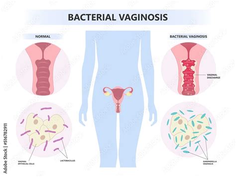 Types Of Herpes Simplex Virus Vagina Bacterial Sex Odor Fishy Foul Smelling Good Preterm Birth