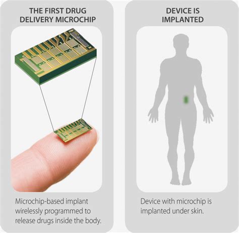 Bill Gates New Remote Controlled Contraceptive Microchip Could Be Used For Eugenics
