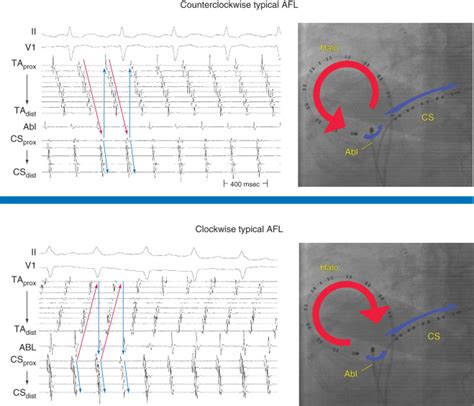 Typical Atrial Flutter Thoracic Key