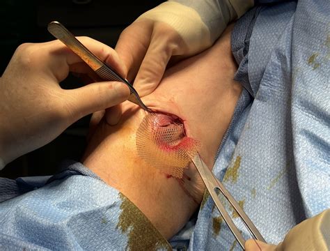 Plastic Surgery Case Study Mesh Pocket Reinforcement In Bicep Implant