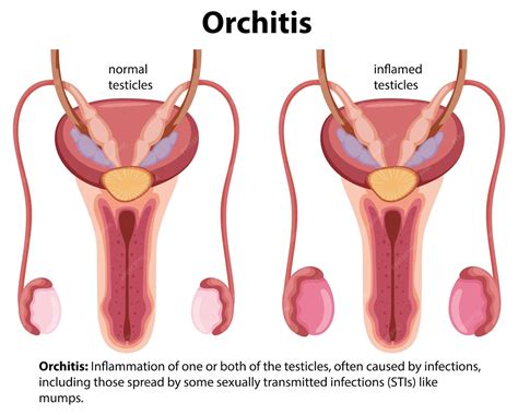 Premium Vector Male Orchitis Testis Infographic Illustration