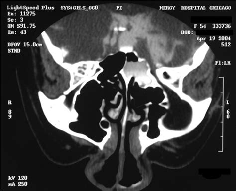 Ct Cisternogram Showing Leakage Of Contrast Material From The