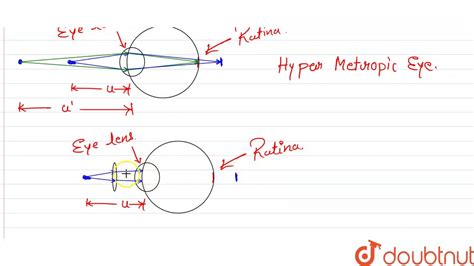 Make A Diagram To Show How Hypermetropia Is Corrected The Near Point