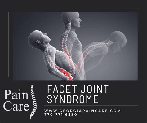 Facet Joint