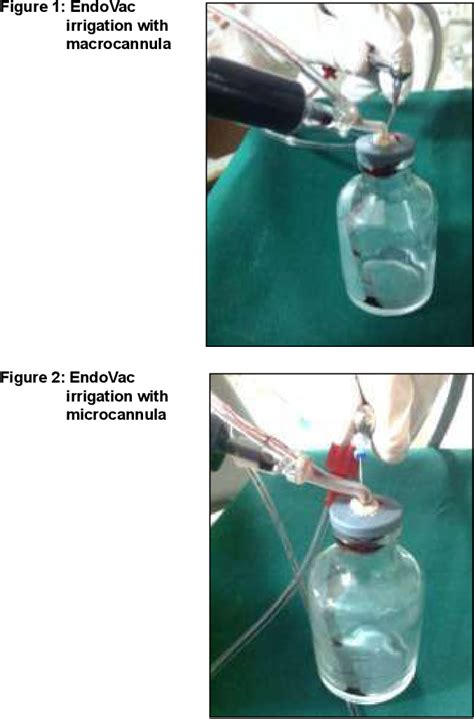 Figure 2 From Comparative Evaluation Of Endovac And Conventional