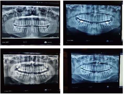 Figure 1 From Semantic Segmentation On Panoramic X Ray Images With U Net Architectures