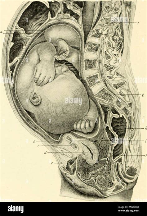A Textbook Of Obstetrics Fig 394 Tapping A Hydrocephalus Through