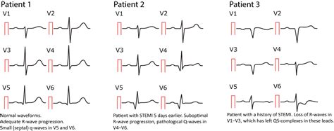 Abnormal Q Wave