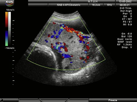 The “rail Sign” An Ultrasound Finding In Placenta Accreta Spectrum