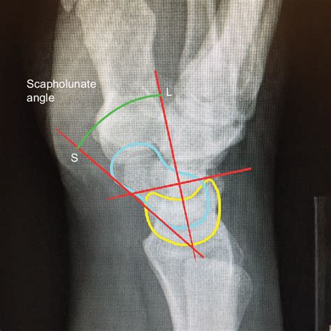 How To Read Wrist Xrays Ortho Conditioning