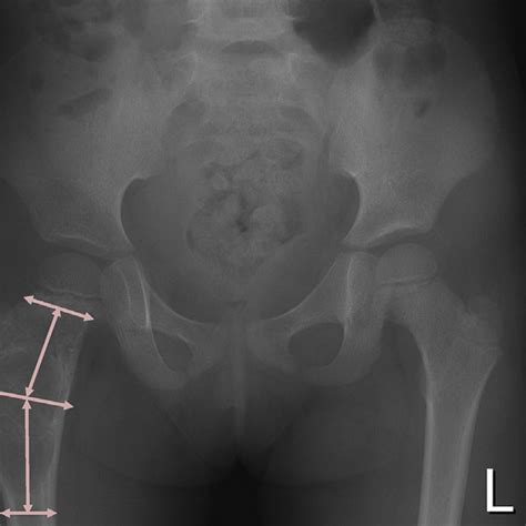 X Ray Taken 28 Months After The First Steroid Injection Neers Grade 2