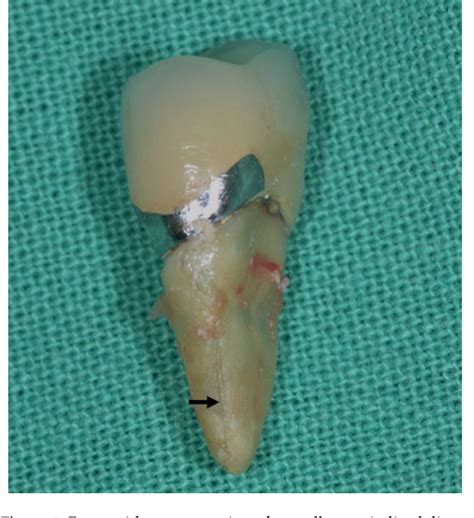 Figure 1 From Vertical Root Fracture In Non Endodontically And Endodontically Treated Teeth