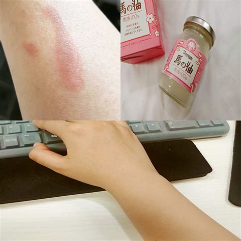 화상흉터없애기 병원 레이저 치료x 네이버 블로그