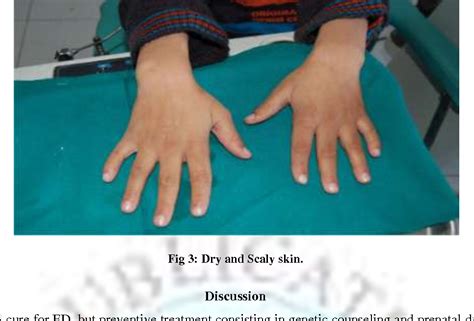 Figure 4 From Anhidrotic Ectodermal Dysplasia The Dental Perspective A Case Report
