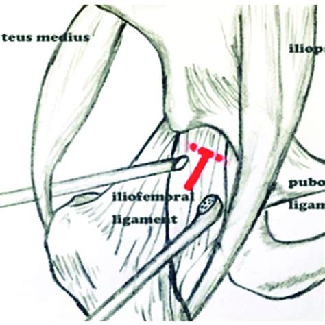 Schematic Indicating The Operating Range Of The Arthroscopic Partial