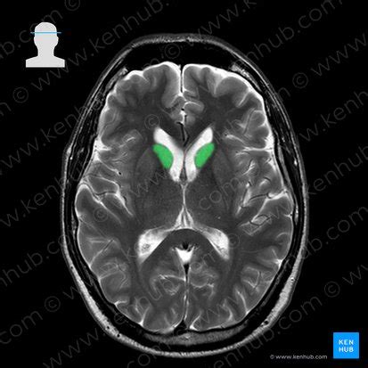 Brain Mri How To Read Mri Brain Scan Kenhub